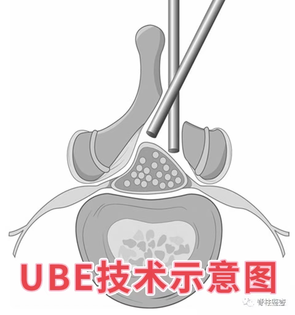 UBE技术，让腰椎病人快速康复！-西安凤城医院[官网] 急救电话：029-86530966